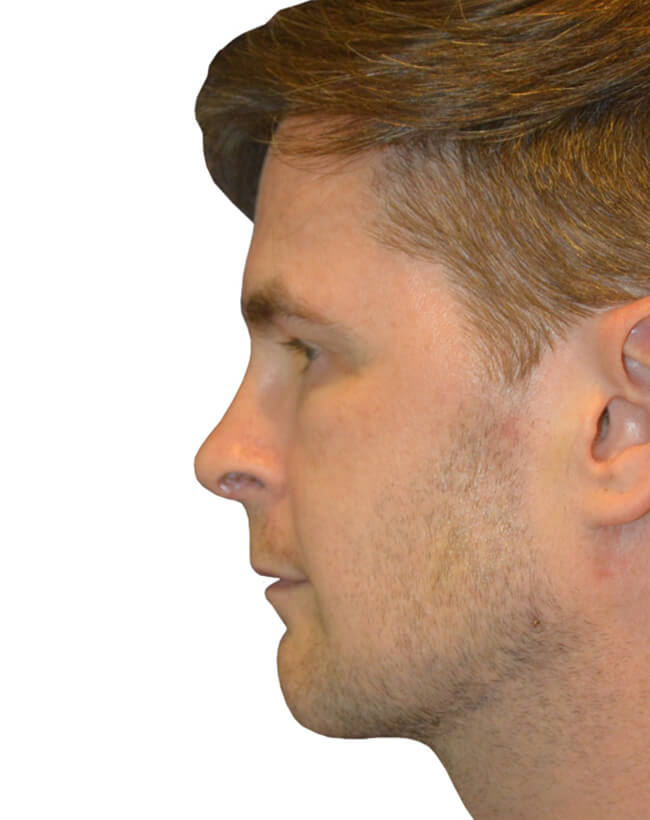 Customized Implants in Beverly Hills, CA | Dr. Jason Diamond