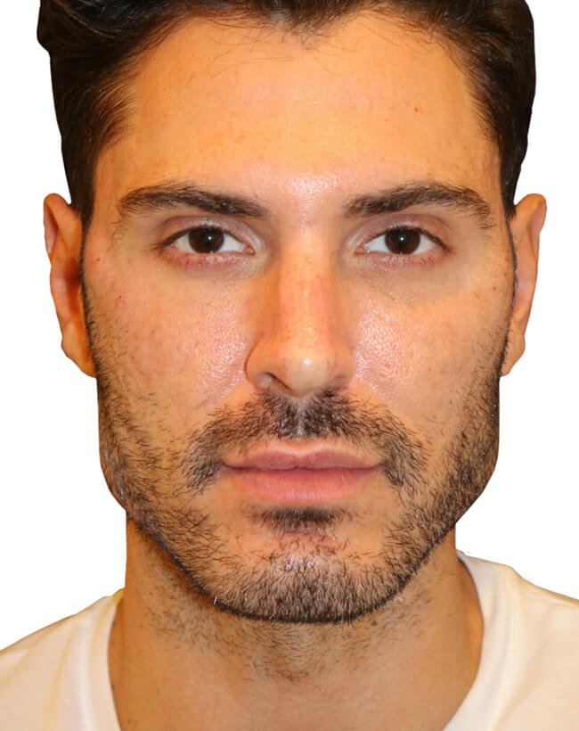 Diamond Facial Sculpting in Beverly Hills, CA | Dr. Jason Diamond