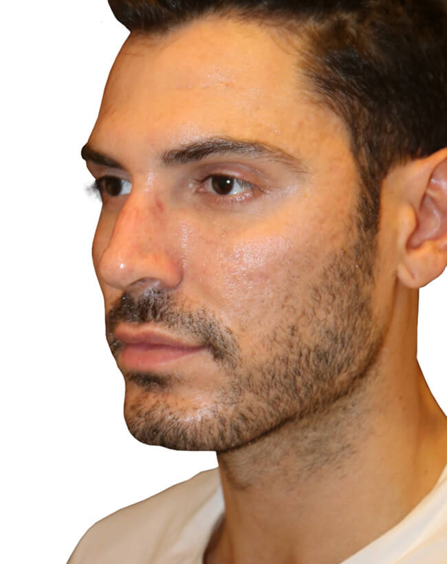 Diamond Facial Sculpting in Beverly Hills, CA | Dr. Jason Diamond